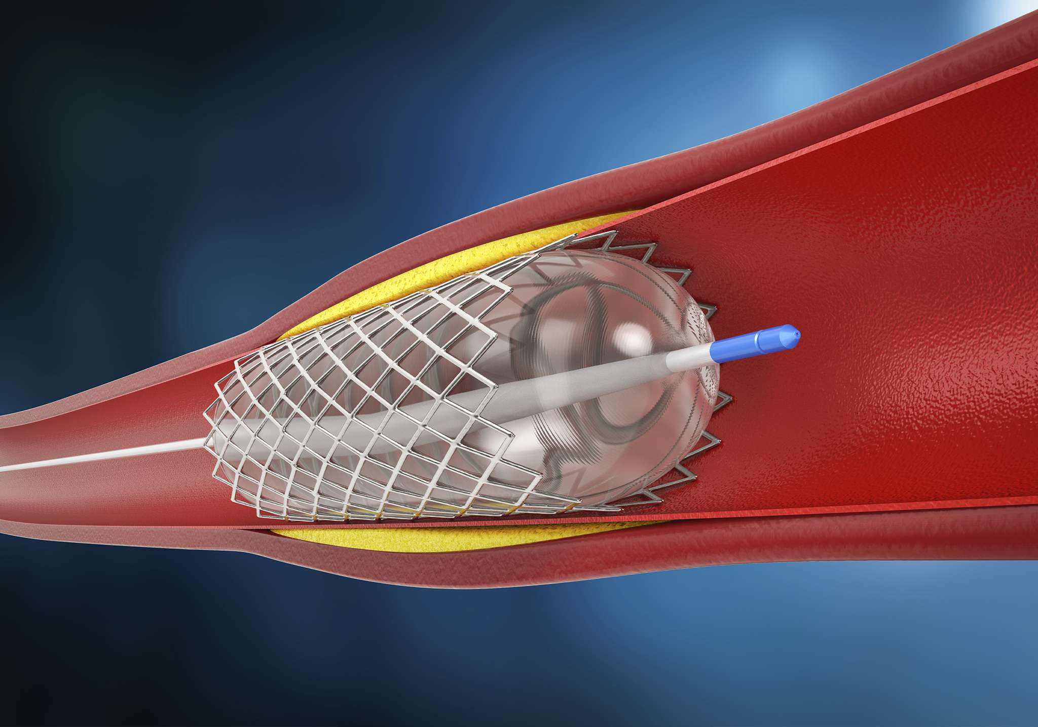 Stent - Vivamed Health